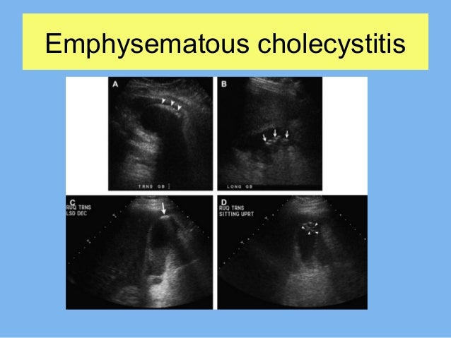 Emphysematous Cholecystitis Ultrasound