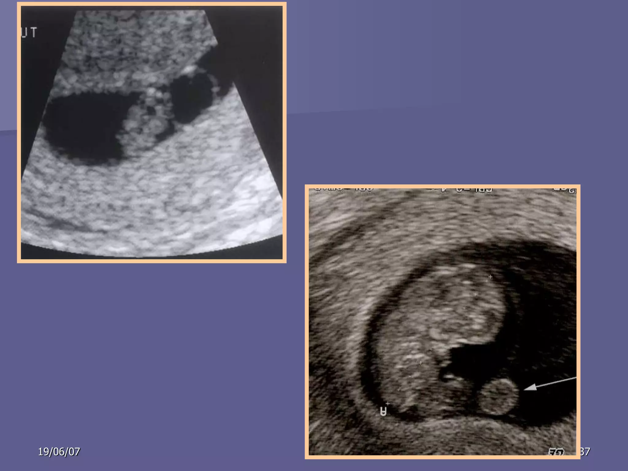ULTRASOUND IN FIRST TRIMESTER.ppt