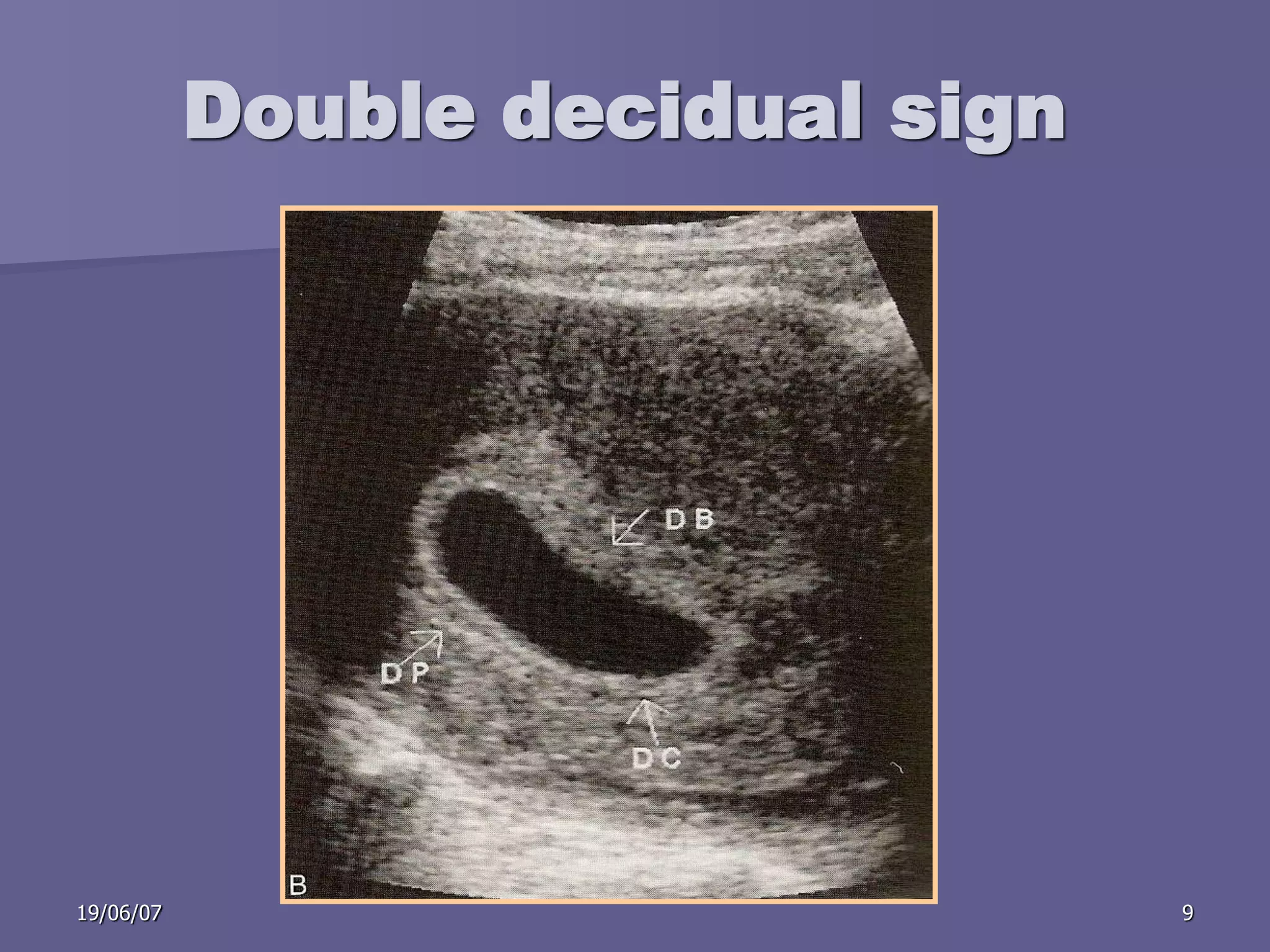 ULTRASOUND IN FIRST TRIMESTER.ppt