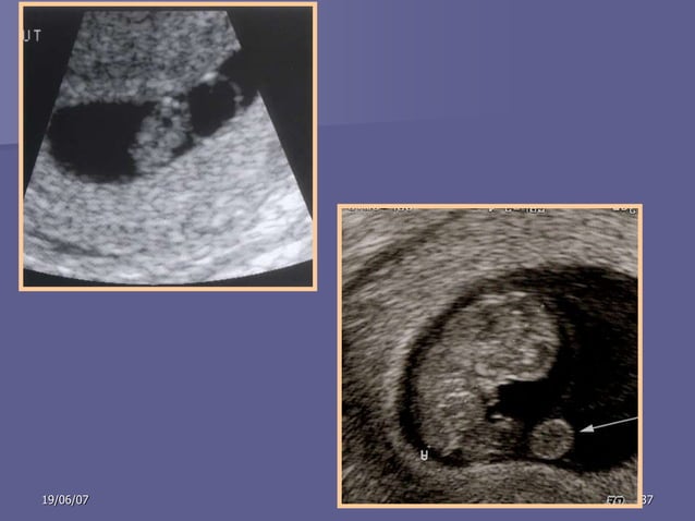 ULTRASOUND IN FIRST TRIMESTER.ppt | Pregnancy | Reproductive Health