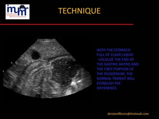 Ultrasound in hypertropic pyloric stenosis | PDF | Pregnancy ...