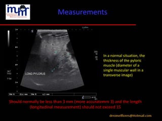 Ultrasound in hypertropic pyloric stenosis | PDF | Pregnancy ...