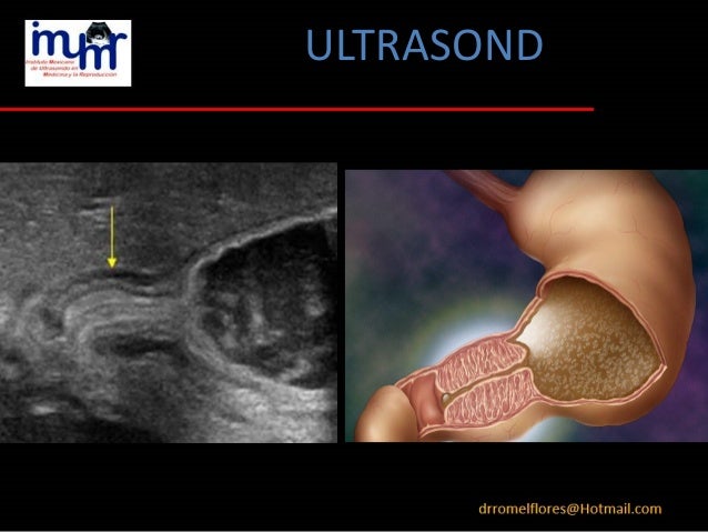 Ultrasound in hypertropic pyloric stenosis