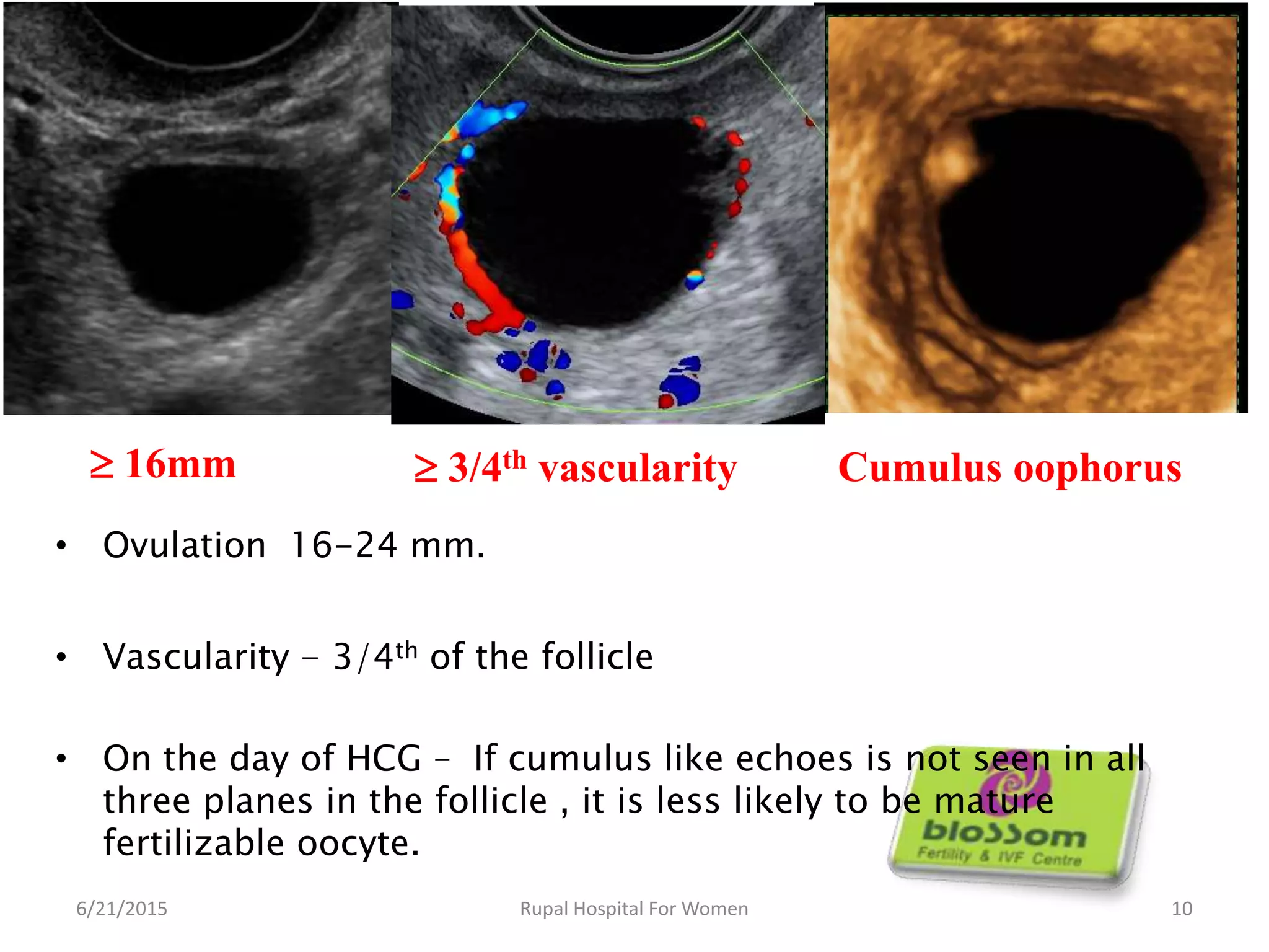 Ultrasound in infertility | PPTX