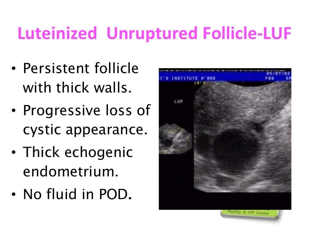 Ultrasound In Infertility