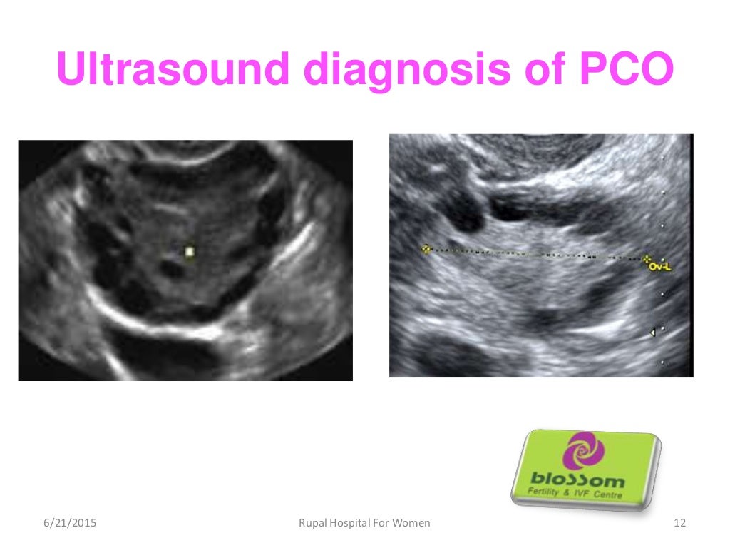 Ultrasound In Infertility