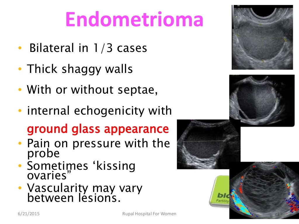 Ultrasound In Infertility