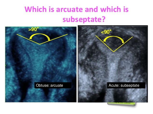 Ultrasound in infertility