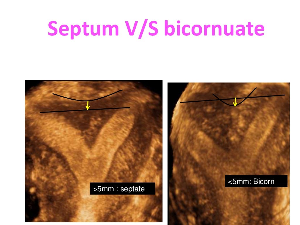 Ultrasound In Infertility