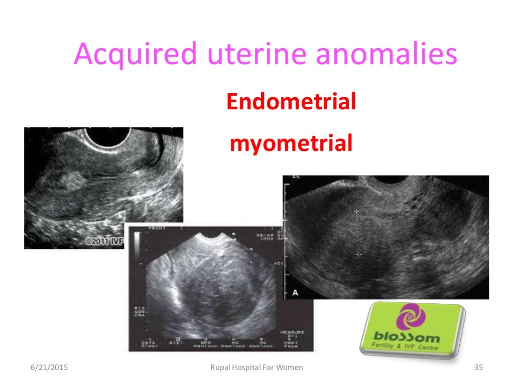 Ultrasound In Infertility