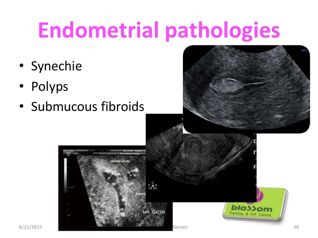 Ultrasound In Infertility