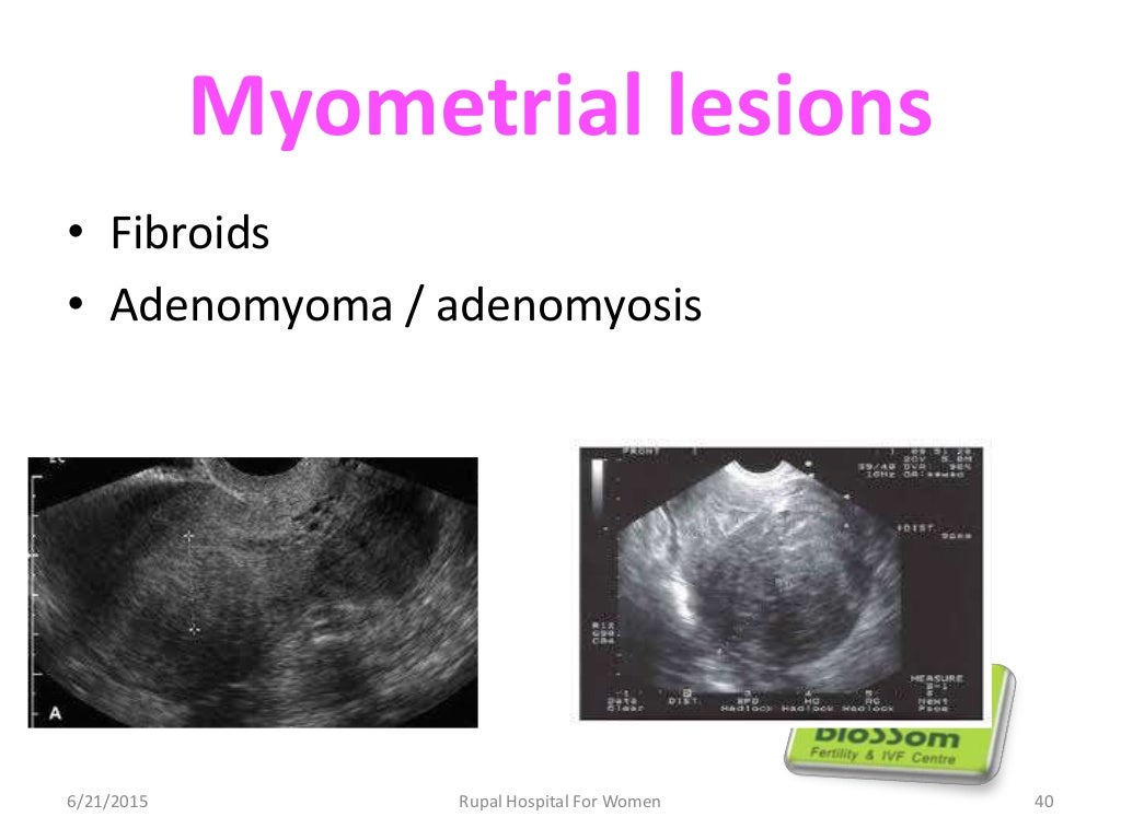 Ultrasound In Infertility