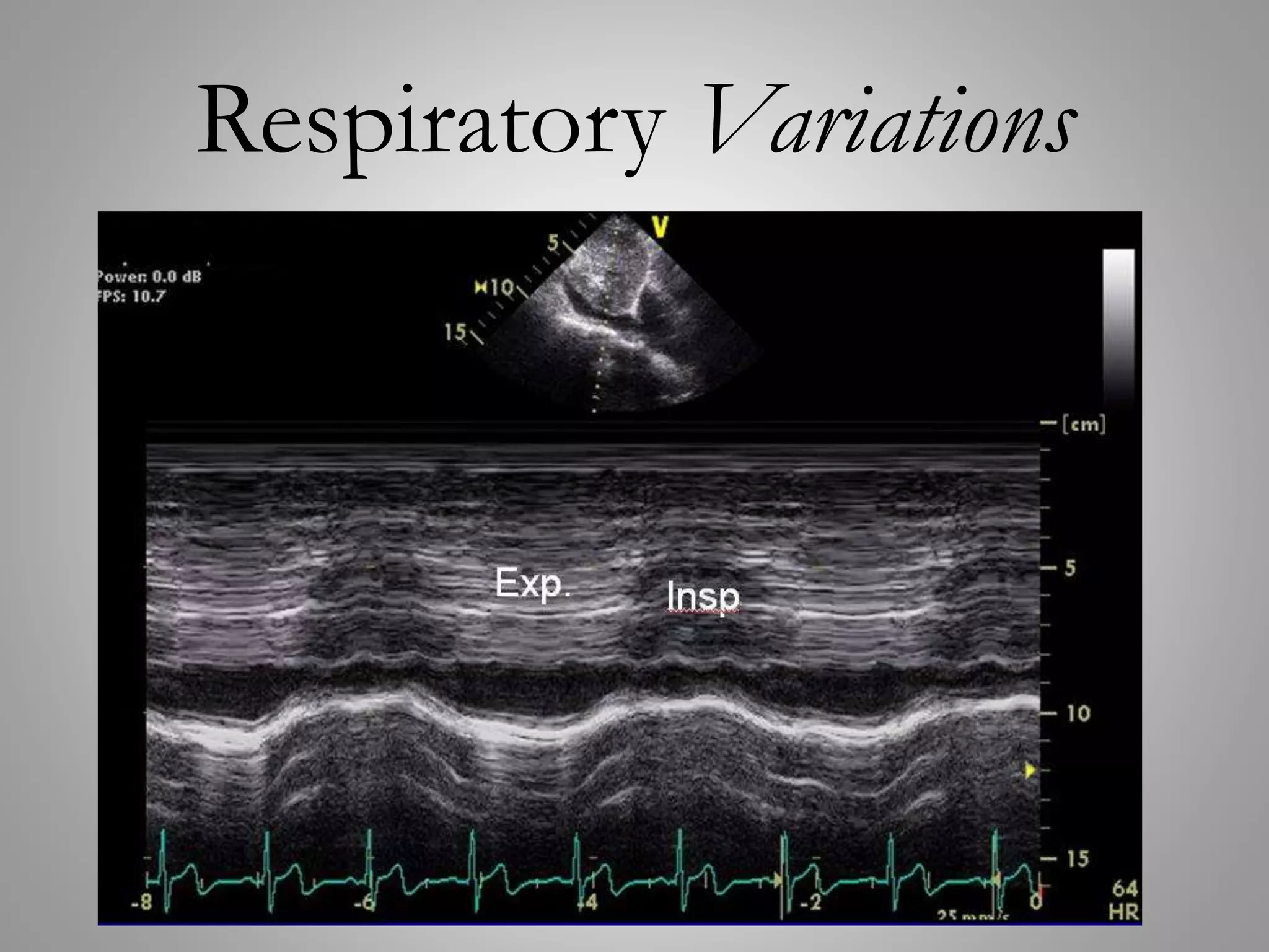 The Evolving Role of Echocardiography in Sepsis | PPTX