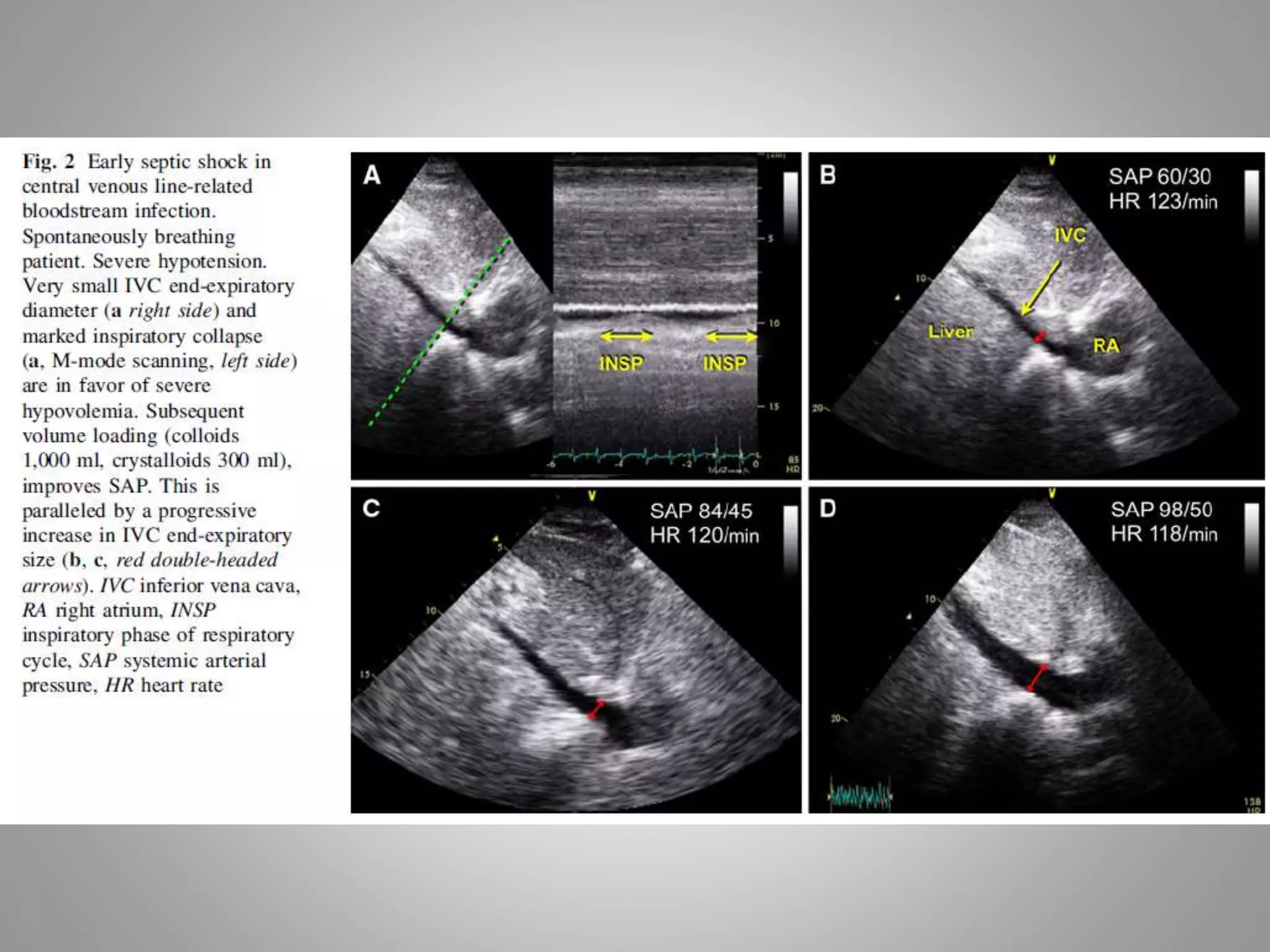 The Evolving Role of Echocardiography in Sepsis | PPTX