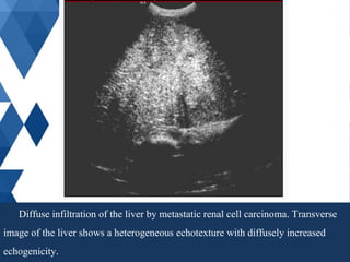 Ultrasound liver | PPTX