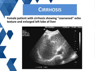 Ultrasound liver | PPTX