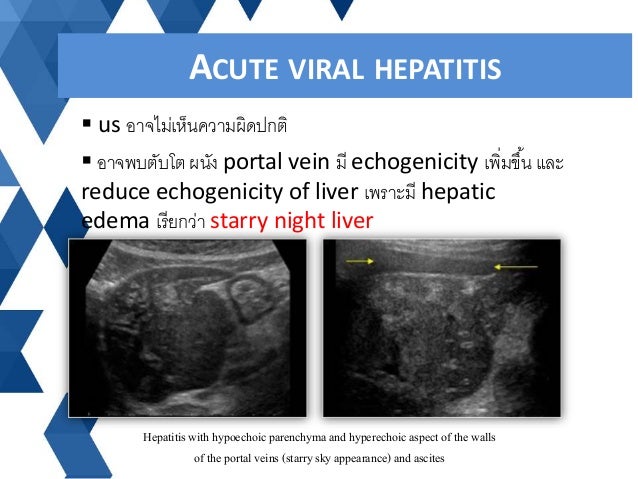 Hepatitis Liver Ultrasound