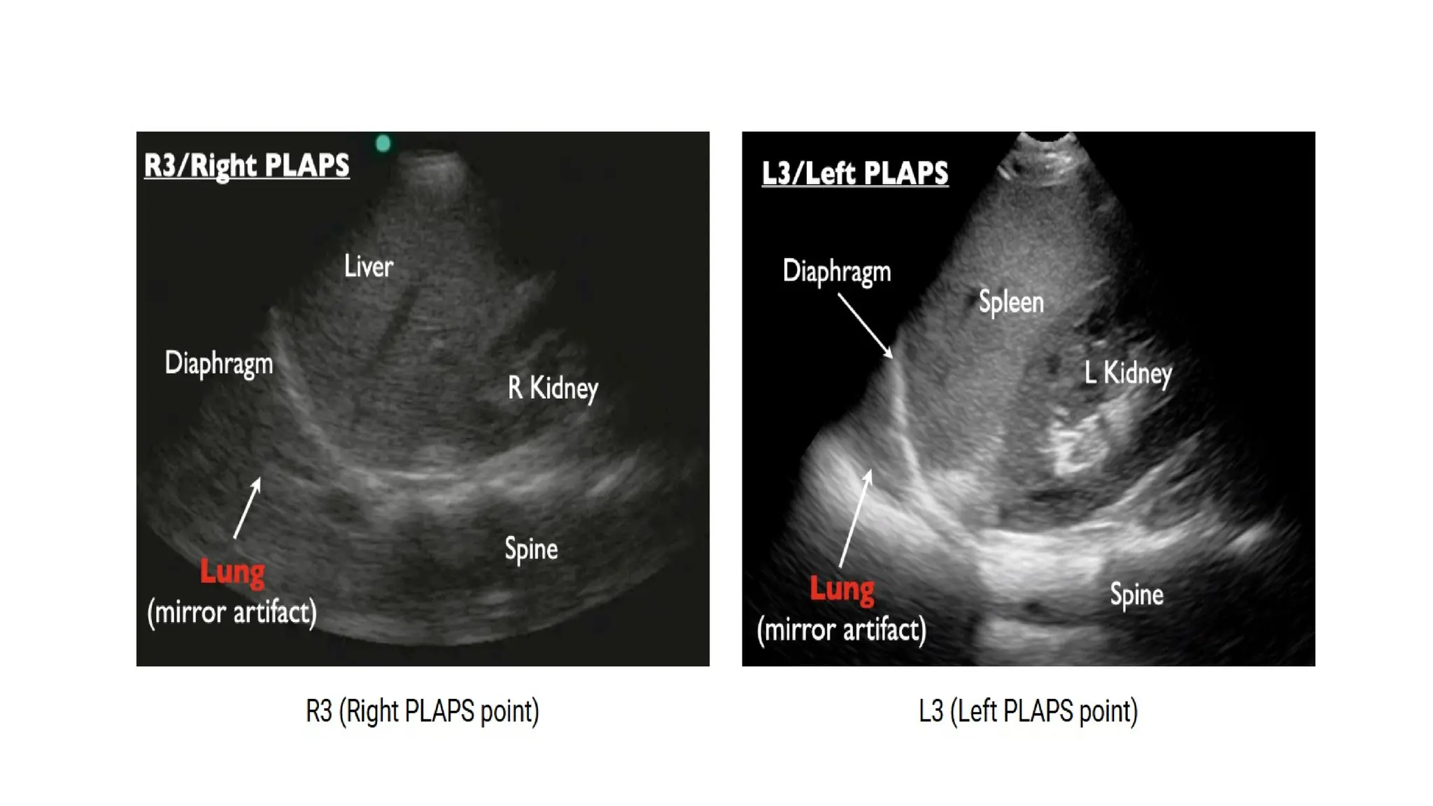 ULTRASOUND LUNG , A short review in POCUS on lung.pptx