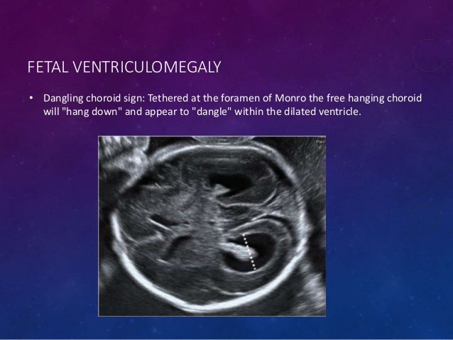 Ultrasound markers of aneuploidy