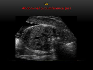 ULTRASOUND my edit.ppt