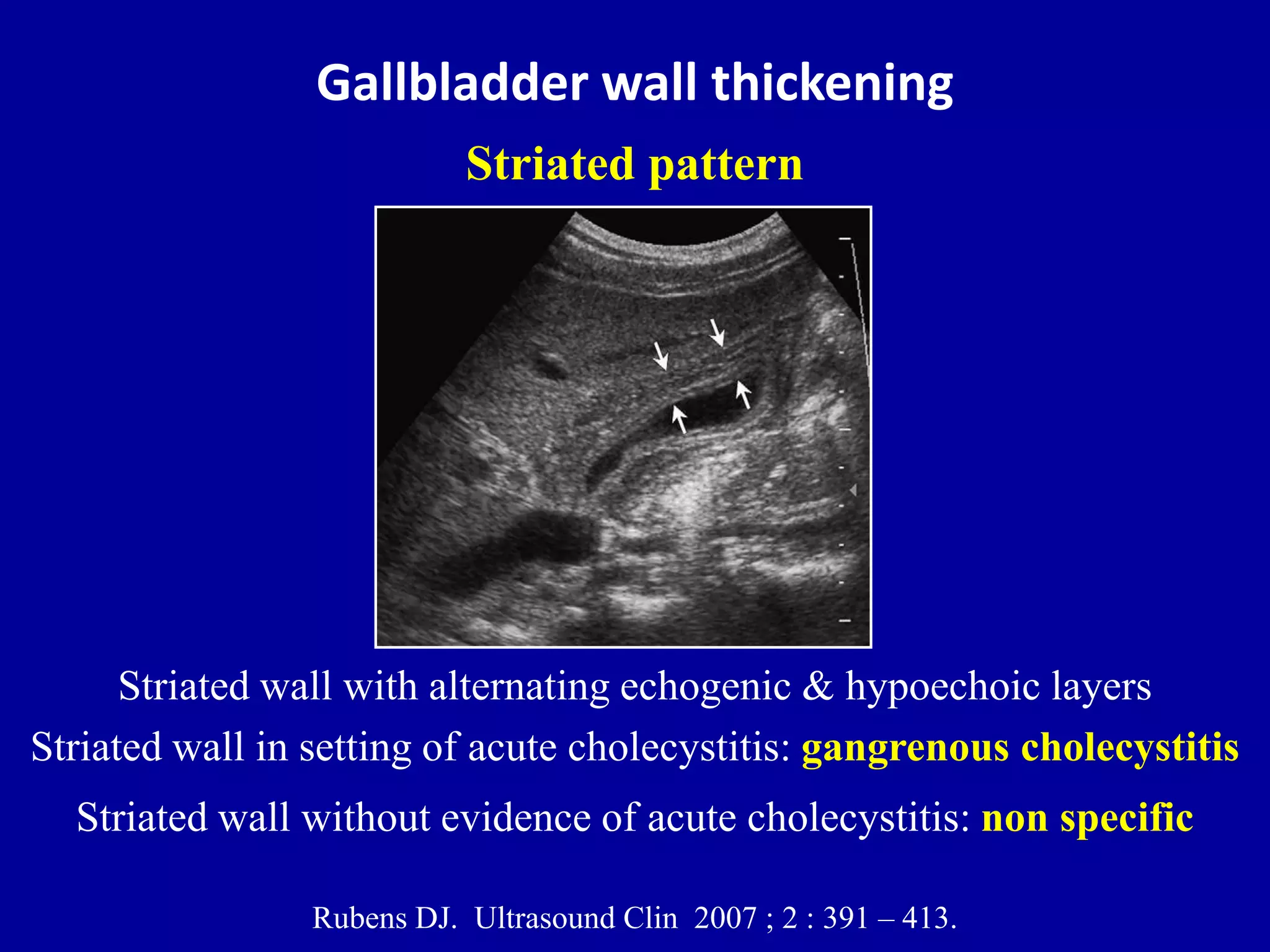Ultrasound of acute & chronic cholecystitis | PPTX