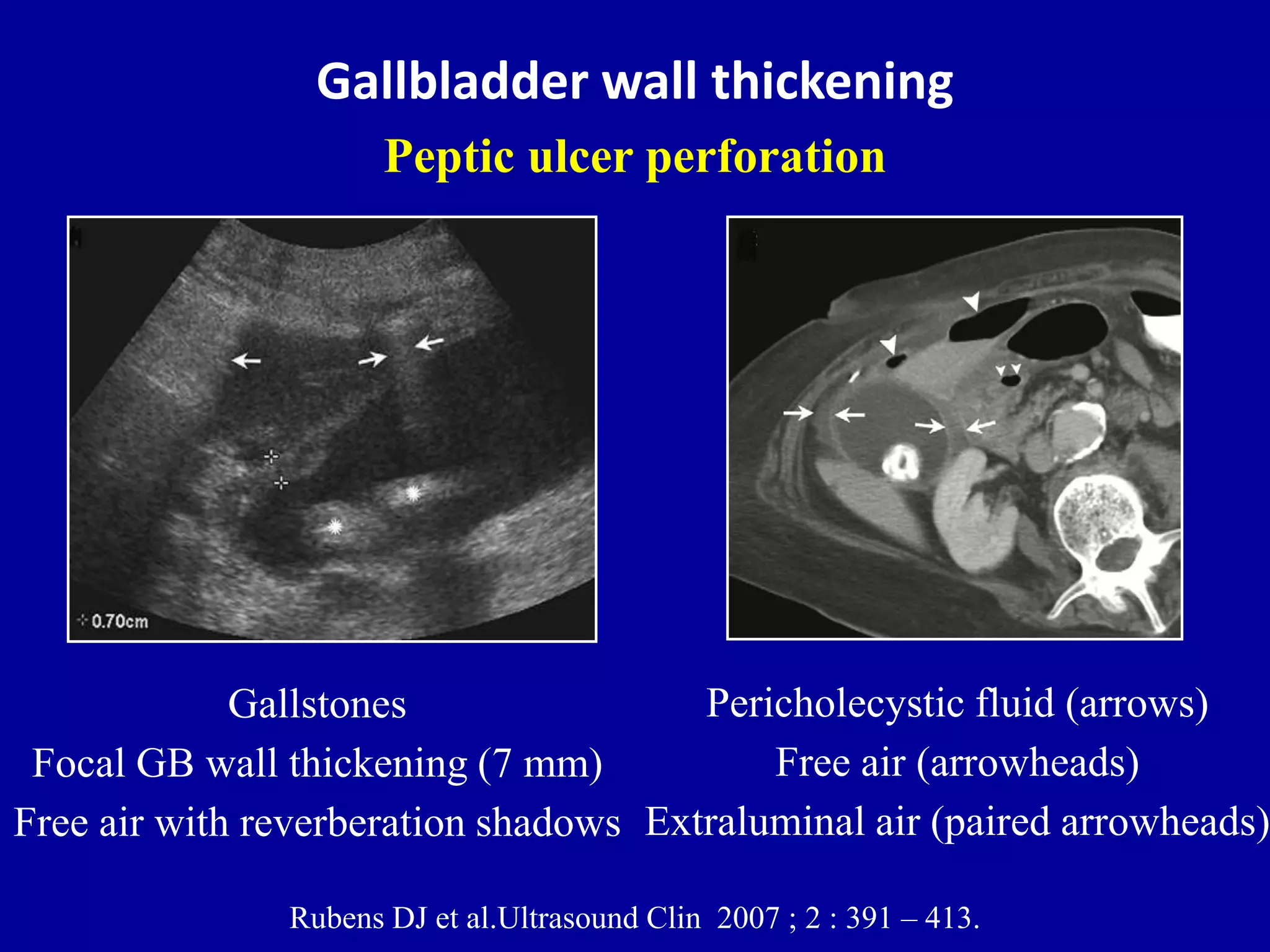 Ultrasound of acute & chronic cholecystitis | PPTX
