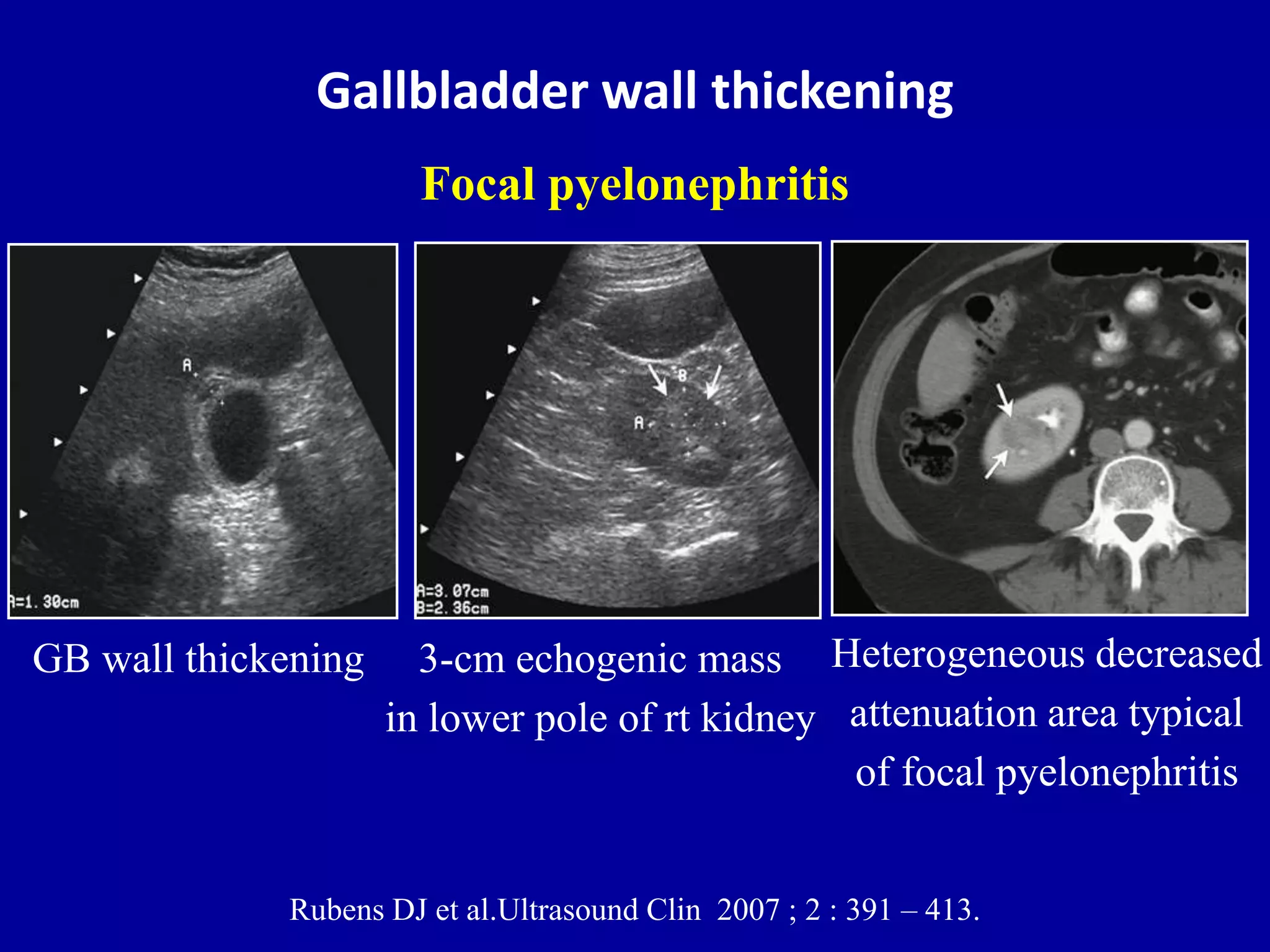 Ultrasound of acute & chronic cholecystitis | PPTX