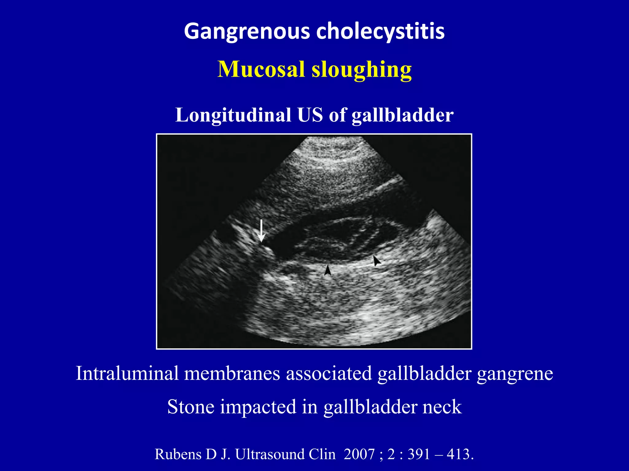 Ultrasound of acute & chronic cholecystitis | PPTX