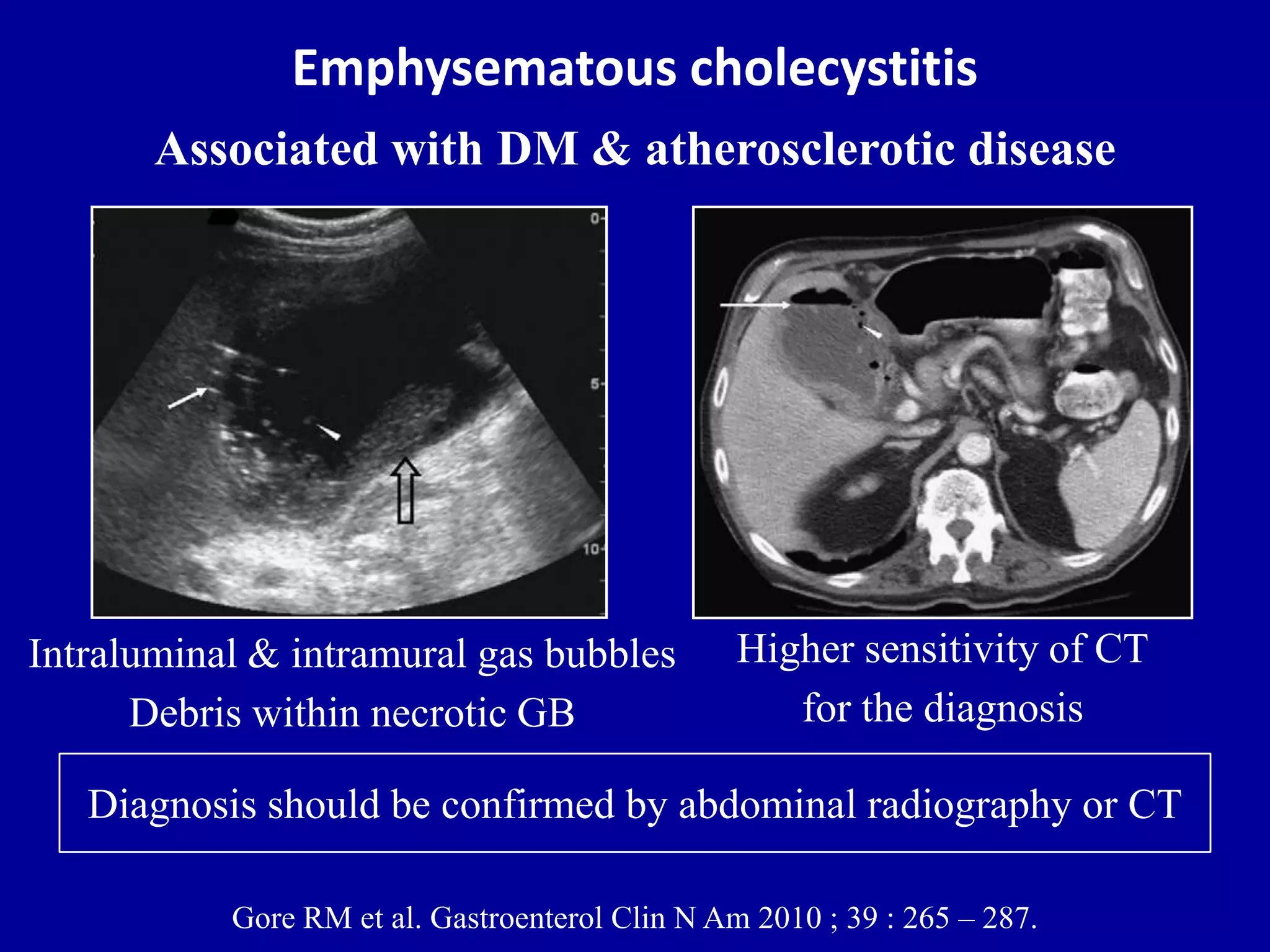 Ultrasound of acute & chronic cholecystitis | PPTX