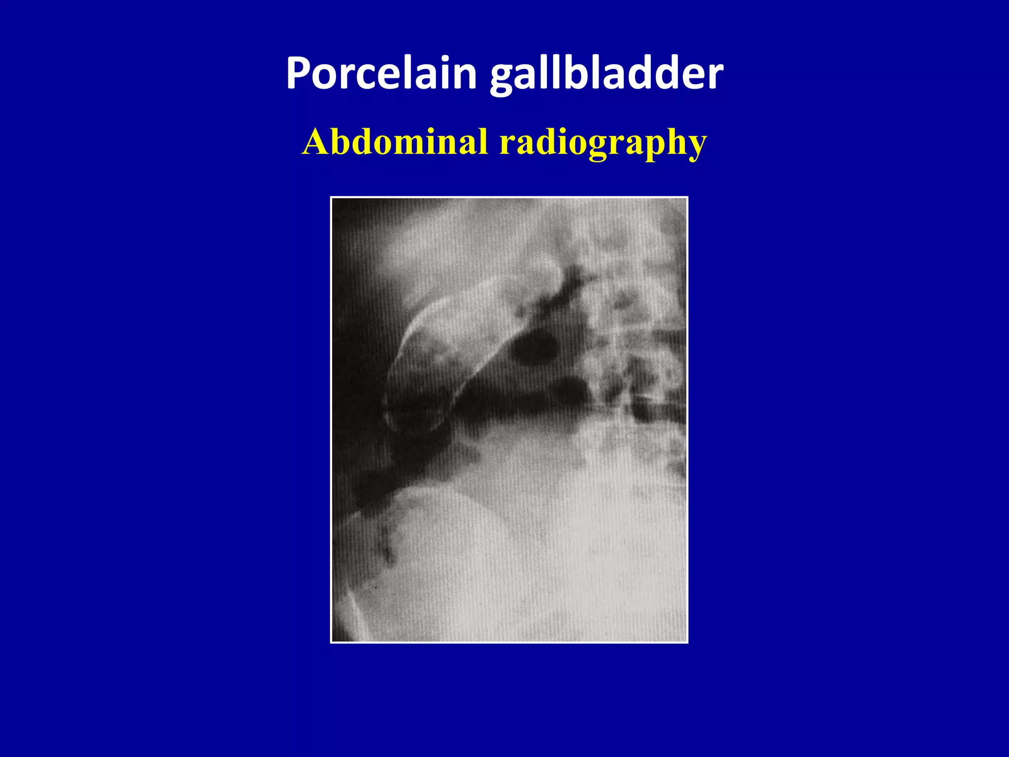 Ultrasound of acute & chronic cholecystitis | PPTX