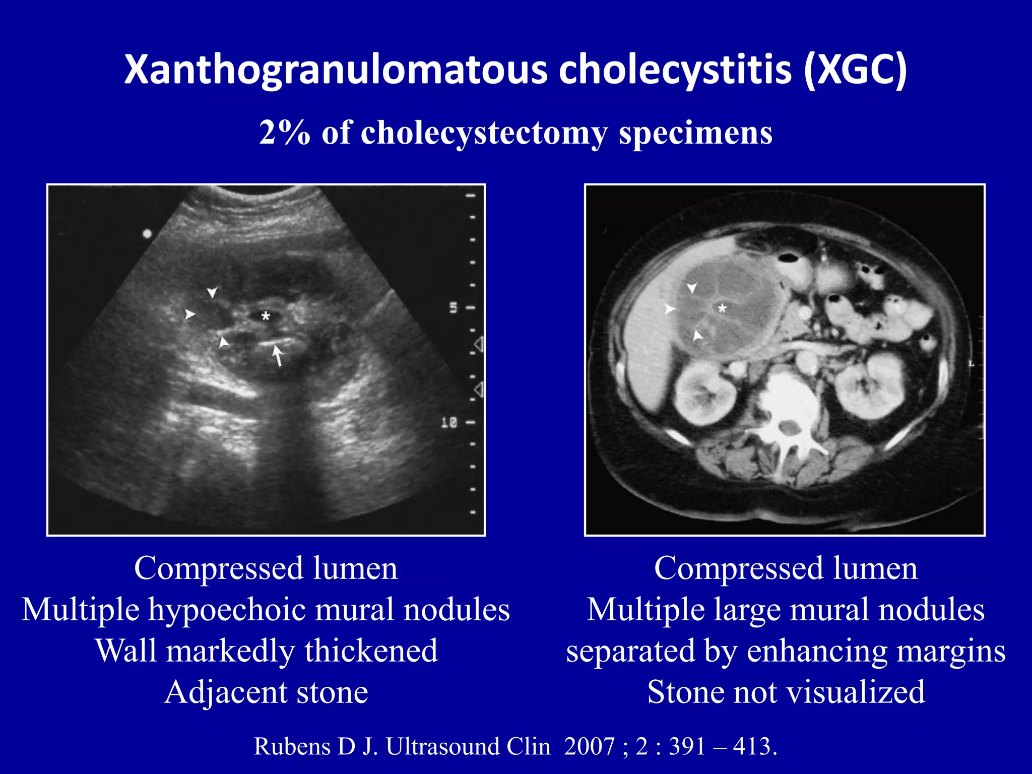 Ultrasound of acute & chronic cholecystitis | PPTX