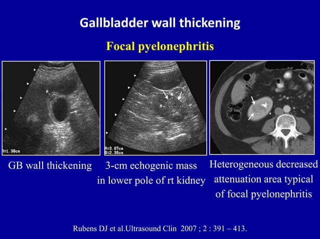 Ultrasound of acute & chronic cholecystitis