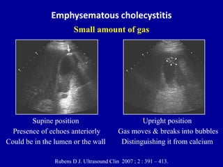 Emphysematous Cholecystitis Ultrasound