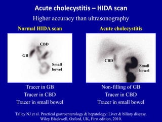 Acalculous Cholecystitis Hida