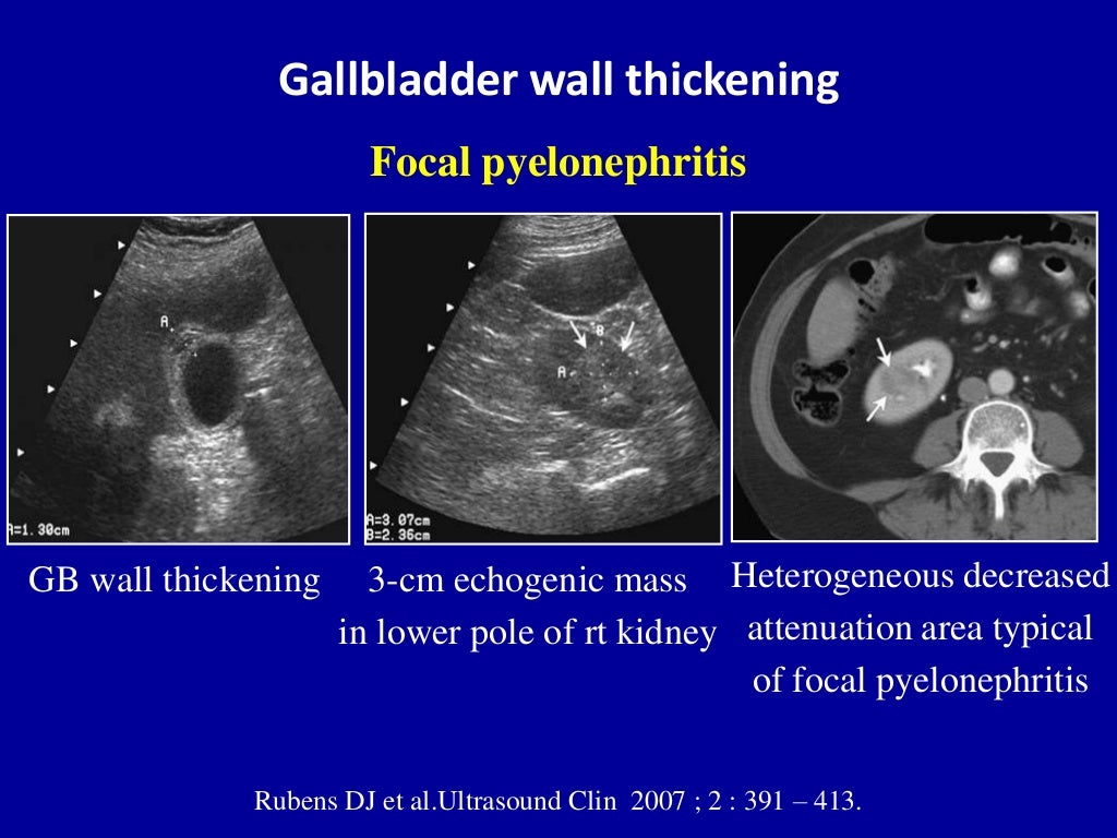 Ultrasound of acute & chronic cholecystitis