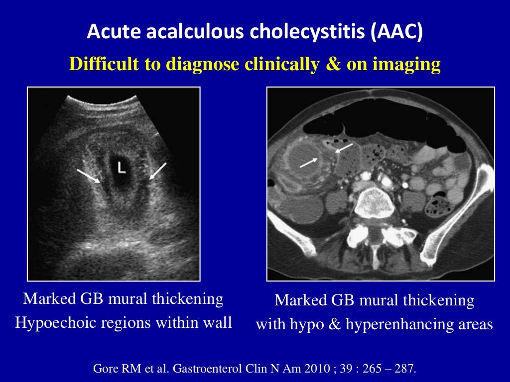 Ultrasound of acute & chronic cholecystitis