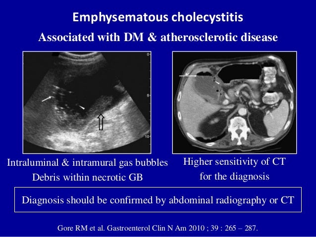 Ultrasound of acute & chronic cholecystitis