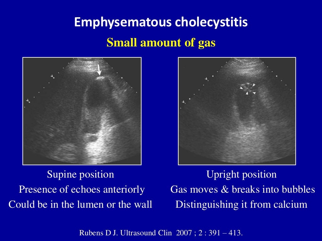 Ultrasound of acute & chronic cholecystitis