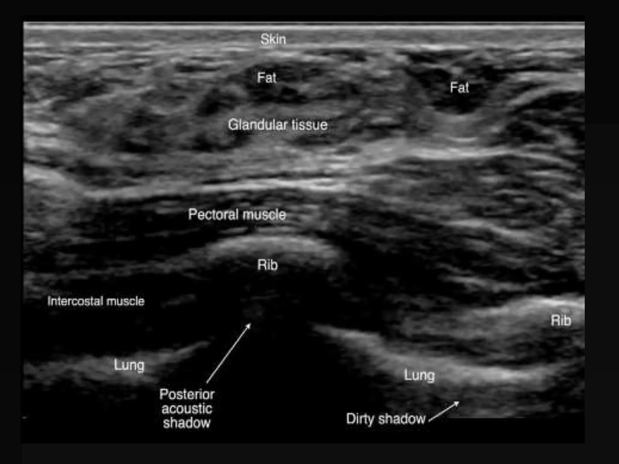 Ultrasound of breast | PPTX