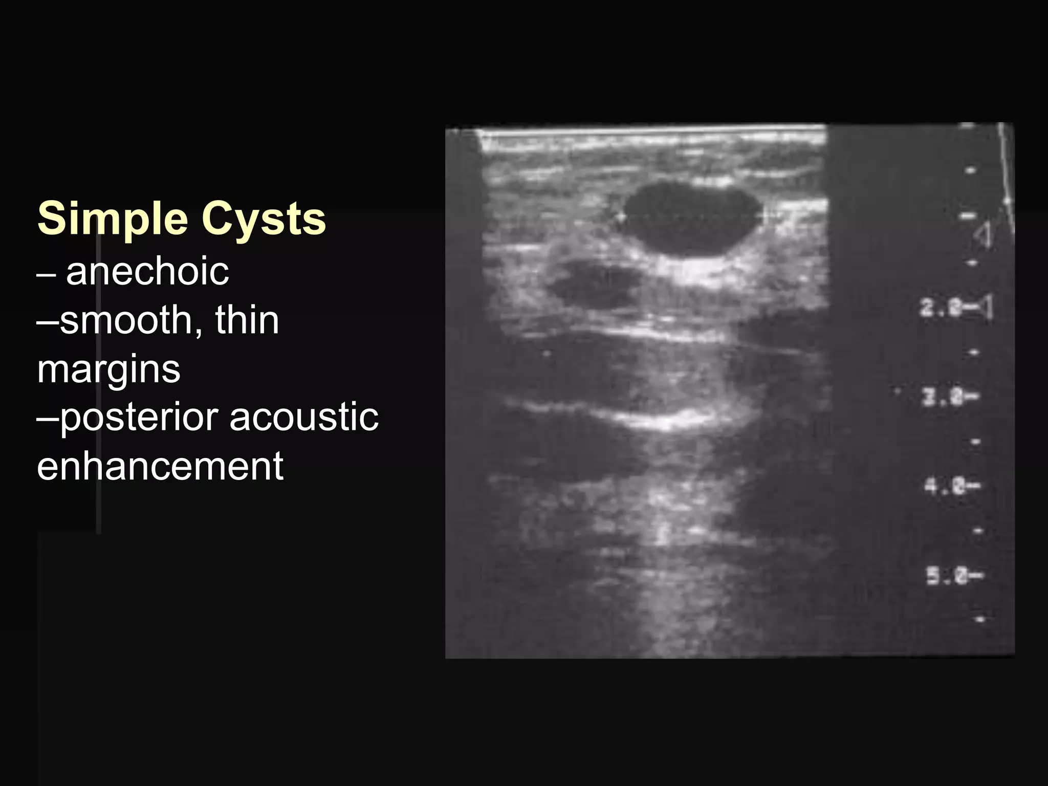 Ultrasound of breast | PPTX