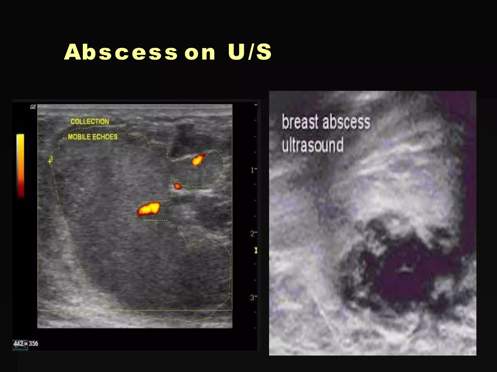 Ultrasound Of Breast Pptx
