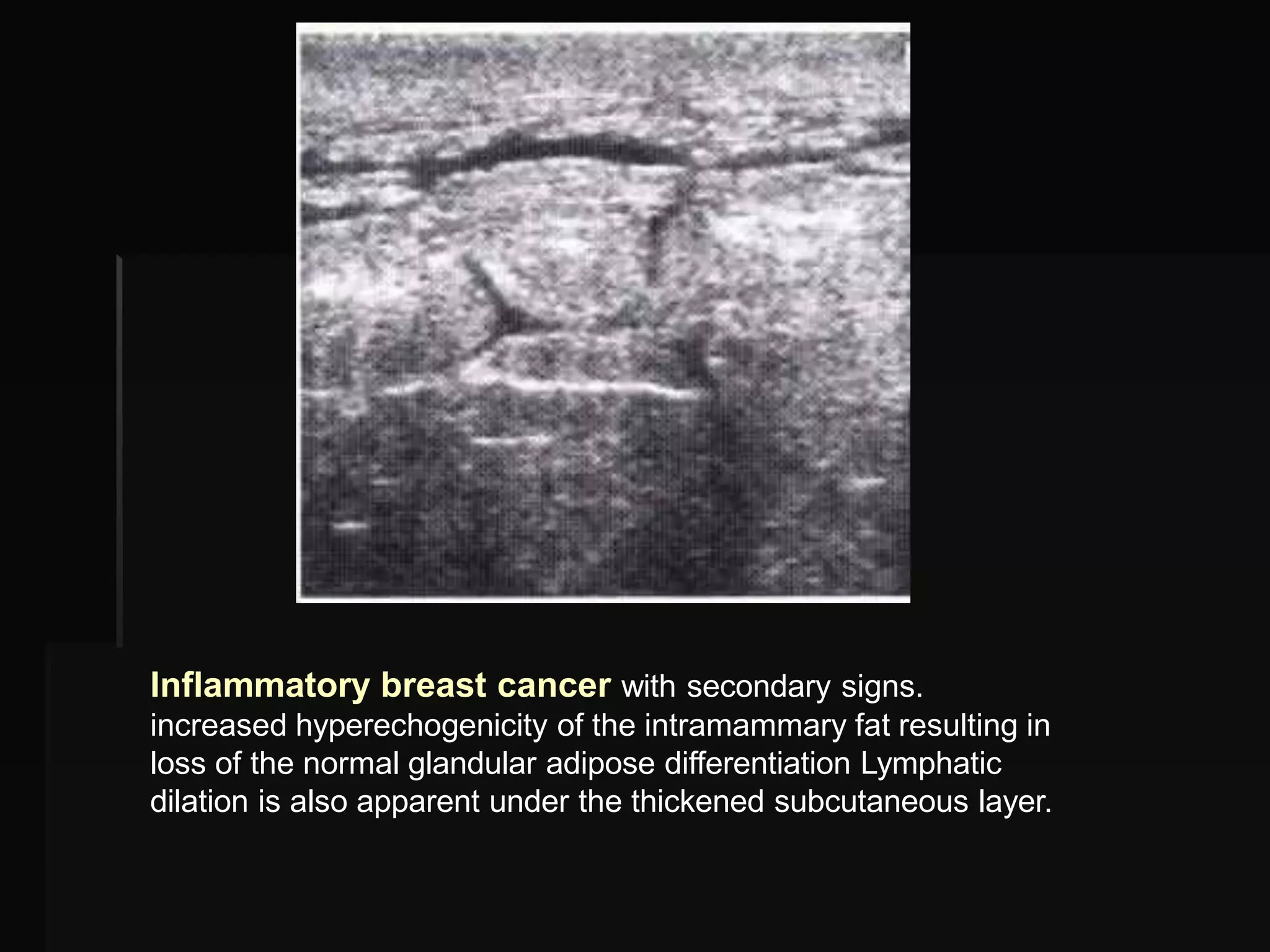 Ultrasound of breast | PPTX