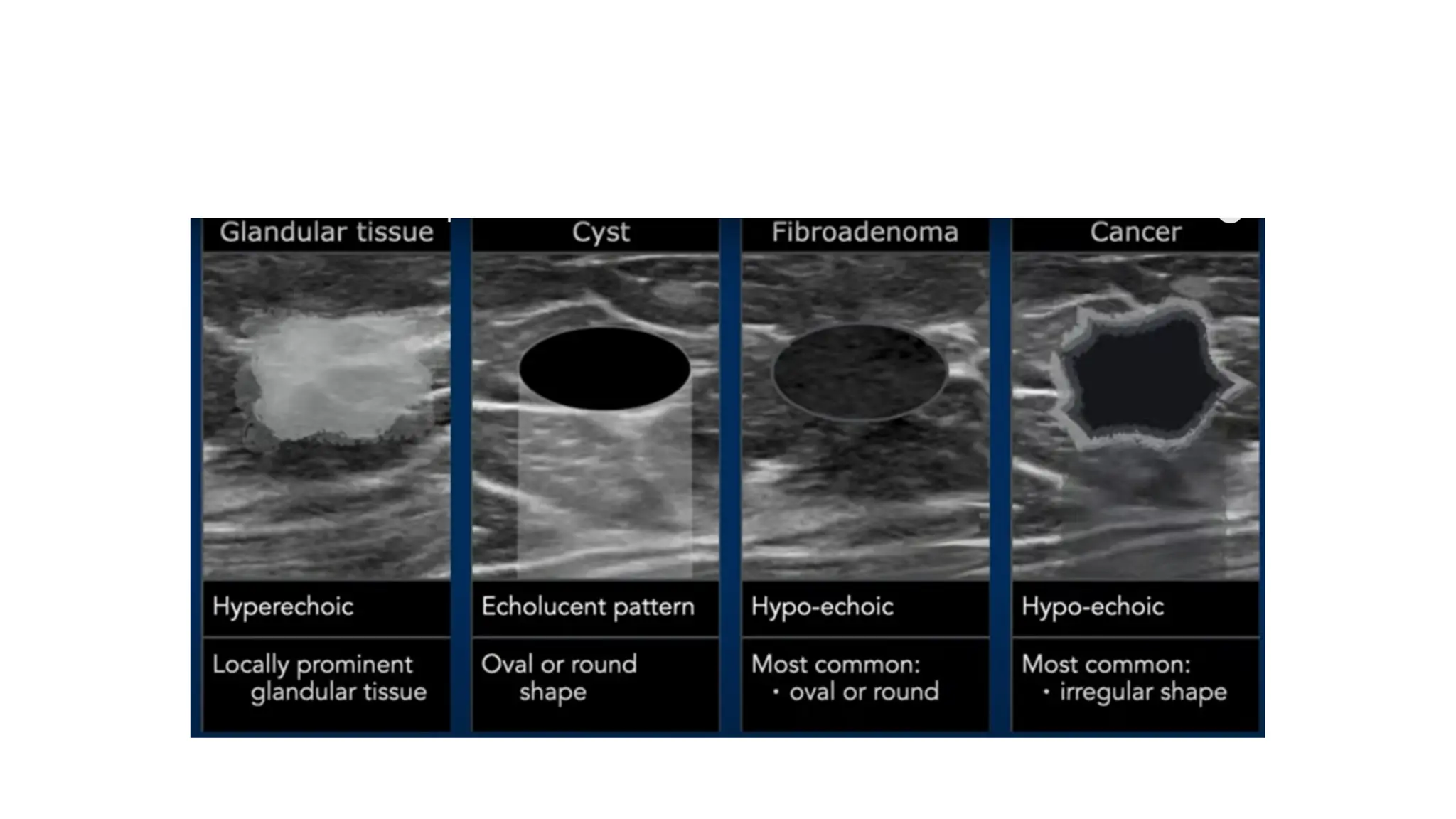 ULTRASOUND OF BREAST by radiology assistant | PPTX