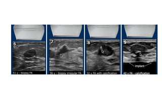 ULTRASOUND OF BREAST by radiology assistant | PPTX