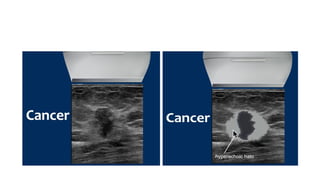 ULTRASOUND OF BREAST by radiology assistant | PPTX