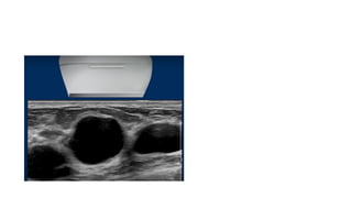 ULTRASOUND OF BREAST by radiology assistant | PPTX