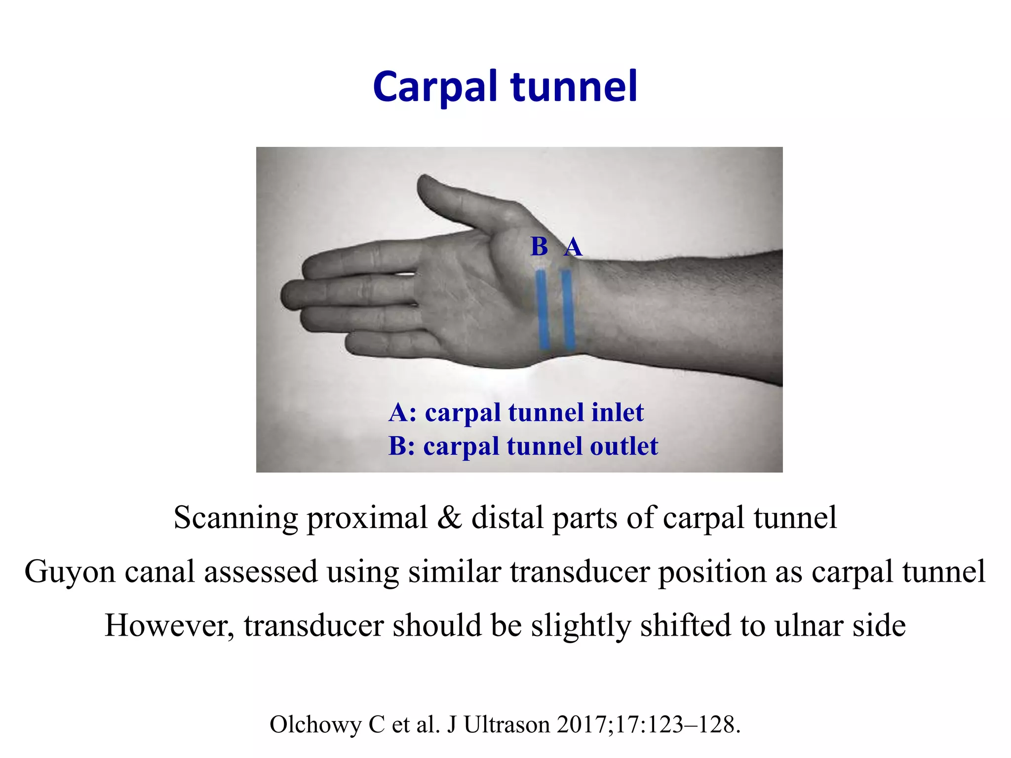 Ultrasound of carpal tunnel syndrome | PPTX