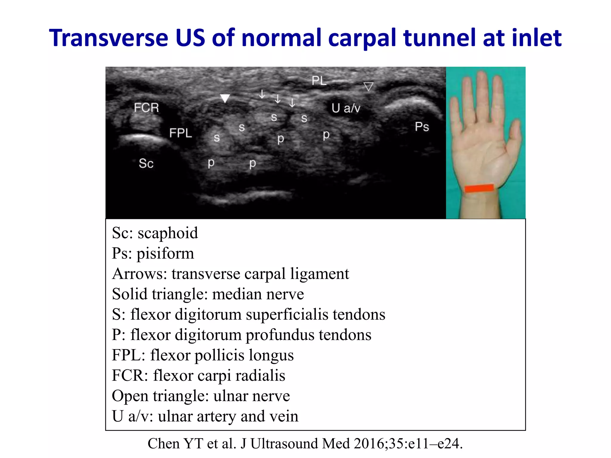 Ultrasound of carpal tunnel syndrome | PPTX