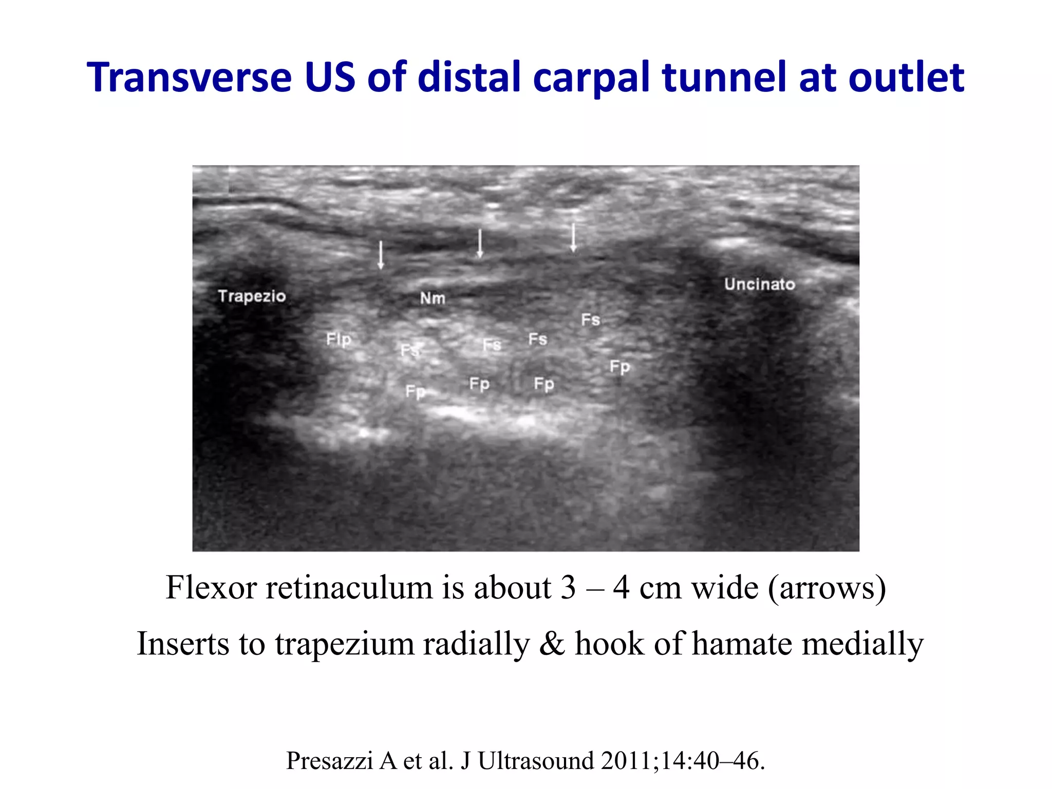 Ultrasound of carpal tunnel syndrome | PPTX