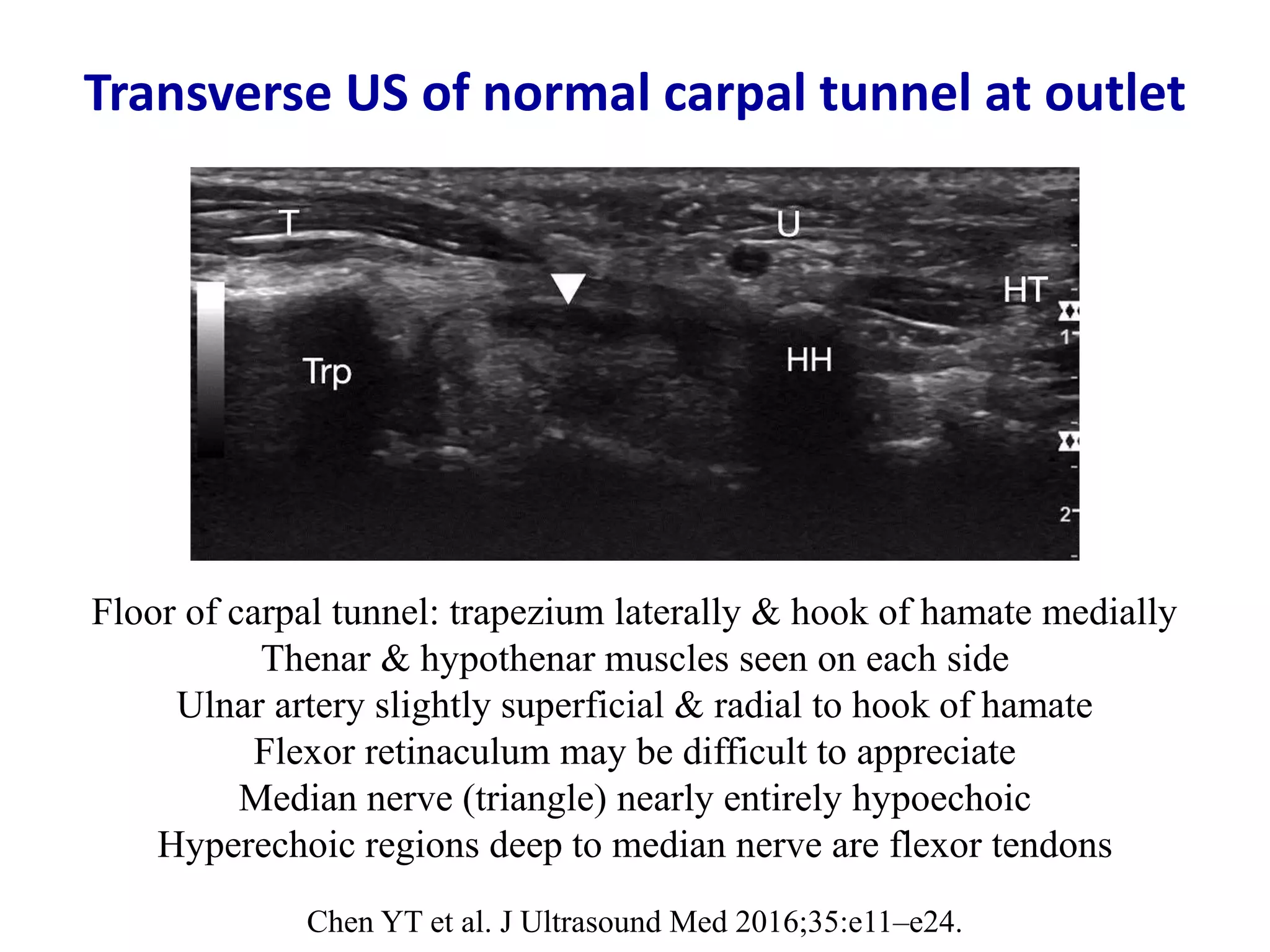 Ultrasound of carpal tunnel syndrome | PPTX